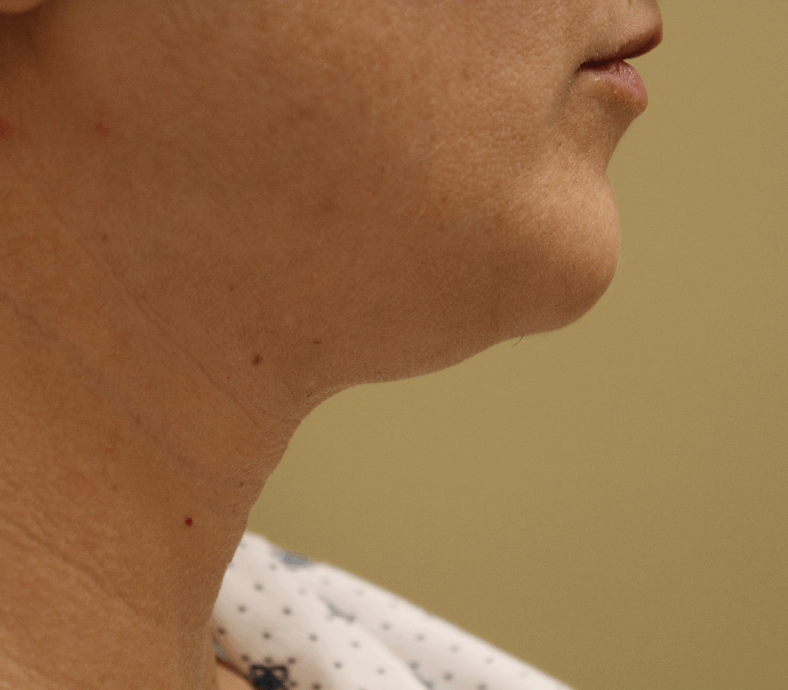 Laser Liposuction Gallery | Morrisville, NC Skincare Experts