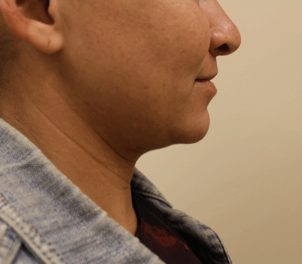 Laser Liposuction Gallery | Morrisville, NC Skincare Experts